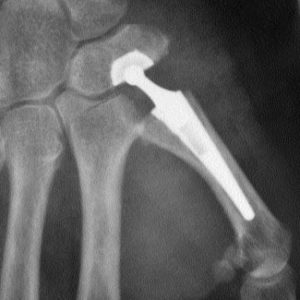 Artrose aan de duimbasis: diagnose & behandelingen | Orthopedie Mortsel