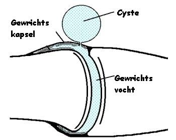 Ganglion of cyste: diagnose en behandelingen | Orthopedie Mortsel