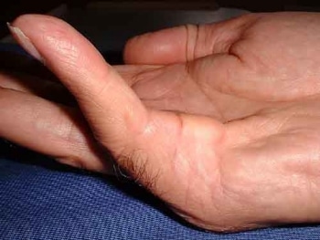 Dupuytren’s Contractuur: diagnose en behandeling | Orthopedie Mortsel