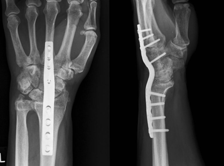 Pols Artrodese | Orthopedie & Traumatologie Mortsel