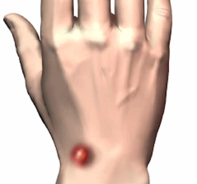 Hand en pols: aandoeningen & ingrepen | Orthopedie Mortsel