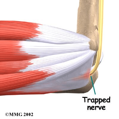 Inklemming van de nervus ulnaris | Orthopedie & Traumatologie Mortsel