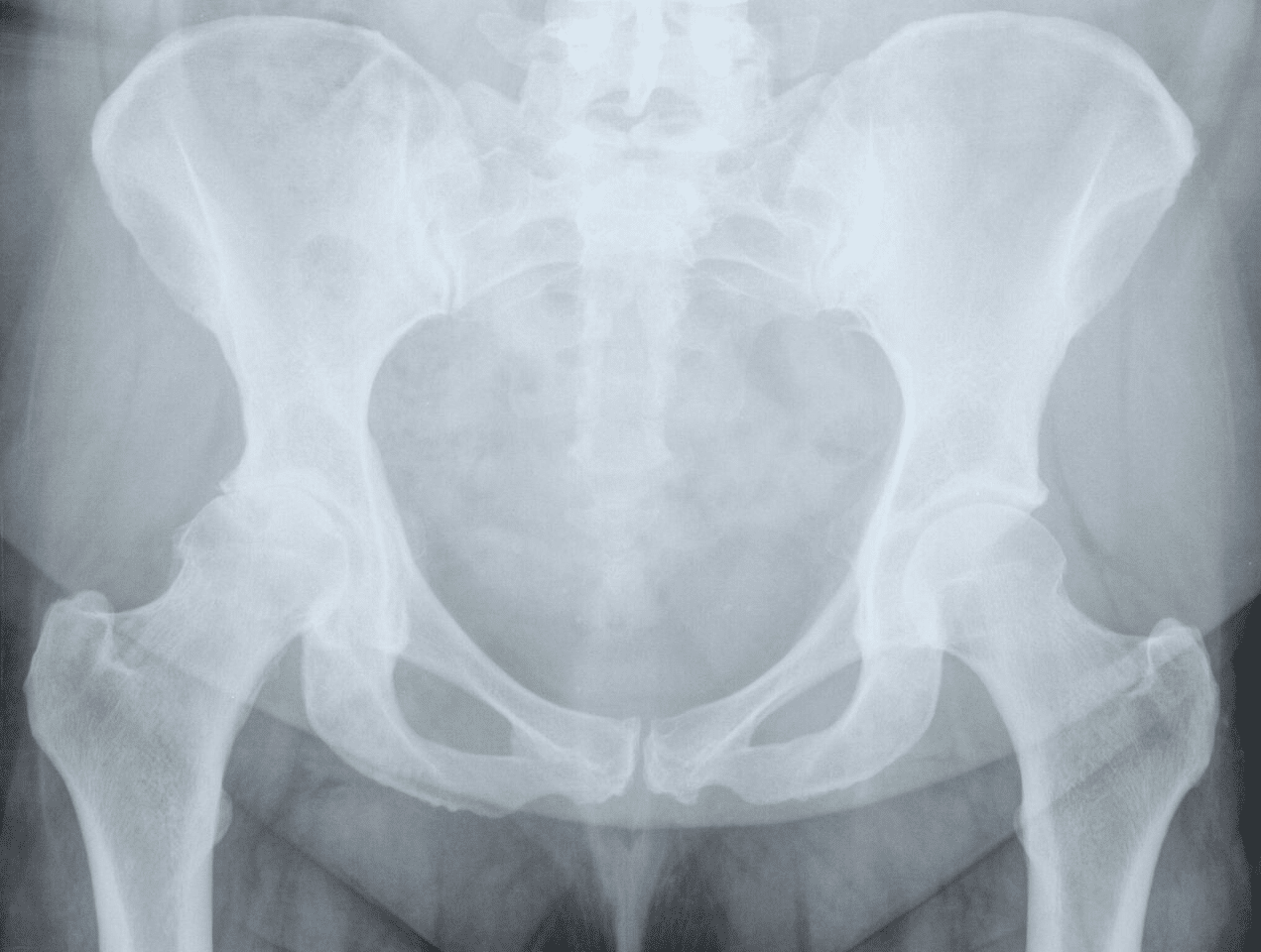 Heup-arthrose: diagnose en behandelingen | Orthopedie Mortsel