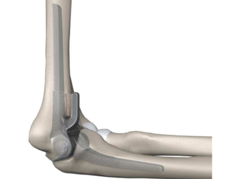 Elleboog: aandoeningen & ingrepen | Orthopedie & Traumatologie Mortsel