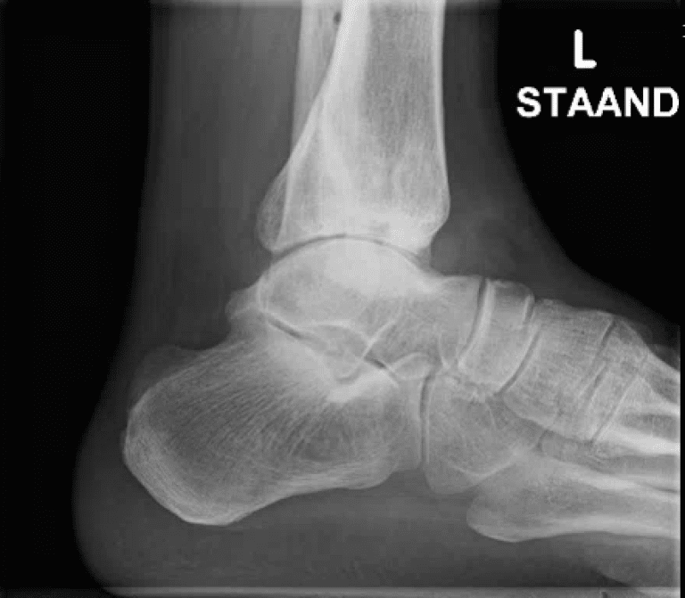 Hallux valgus | Orthopedie & Traumatologie Mortsel