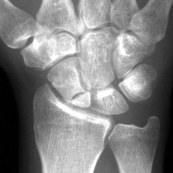 Springvinger: diagnose & behandeling | Orthopedie Mortsel - Antwerpen